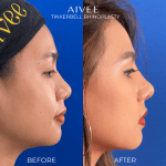 Aivee PRP Hair Restoration | The Aivee Clinic