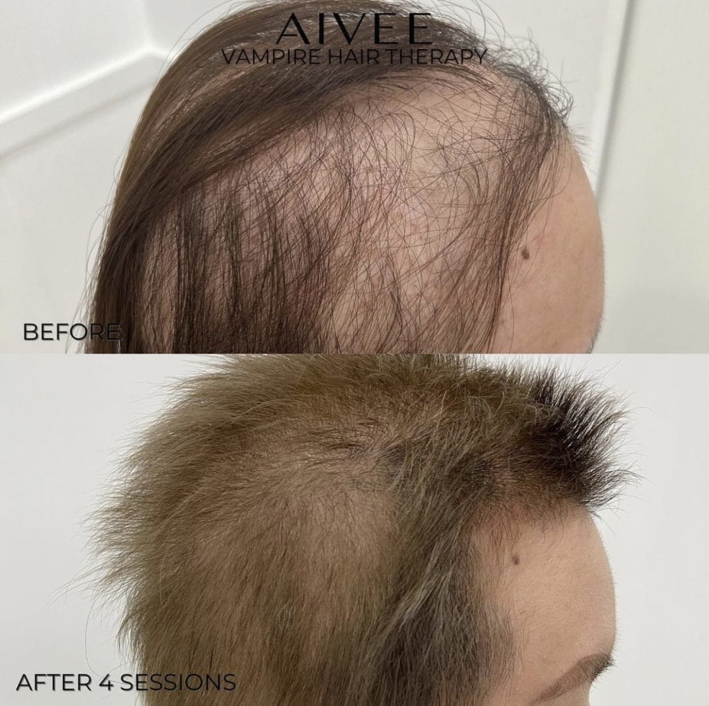 AIVEE VAMPIRE HAIR THERAPY 1 | The Aivee Group