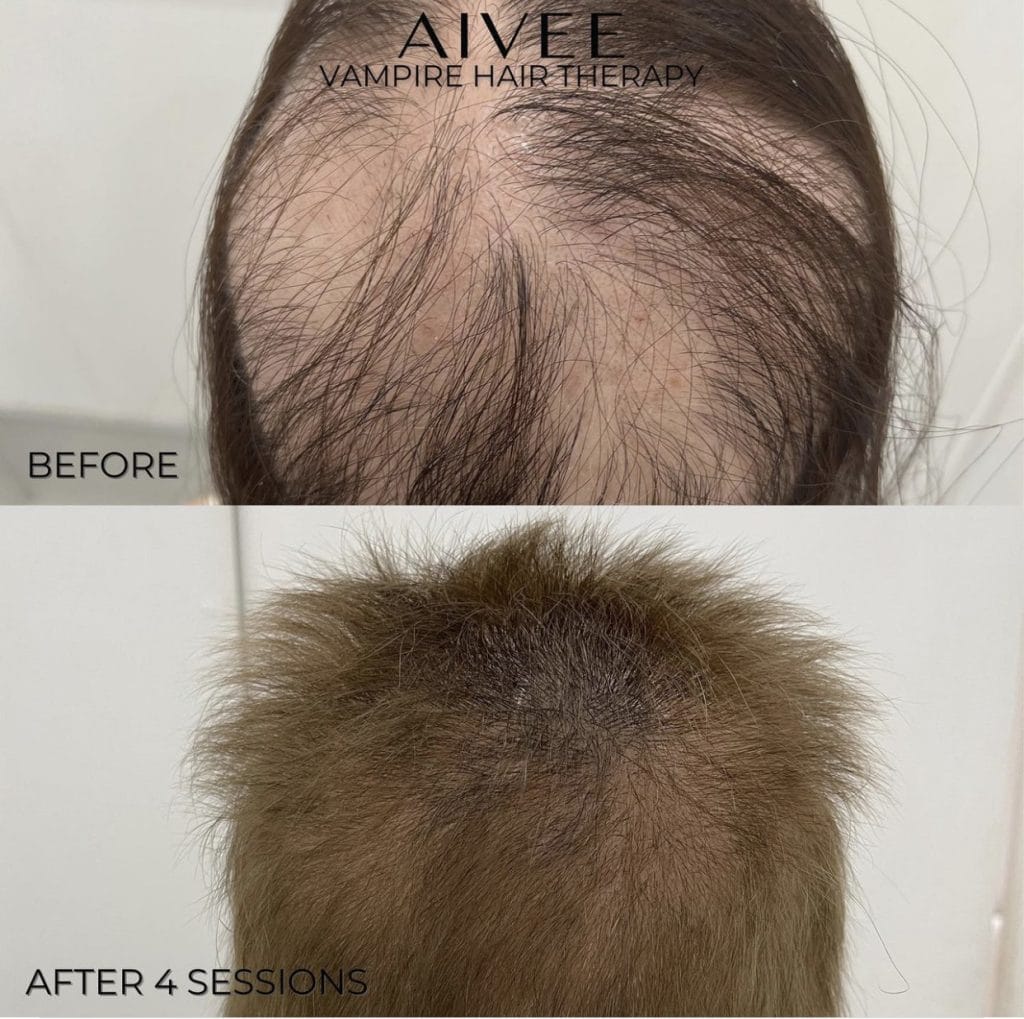 AIVEE VAMPIRE HAIR THERAPY 3 | The Aivee Clinic
