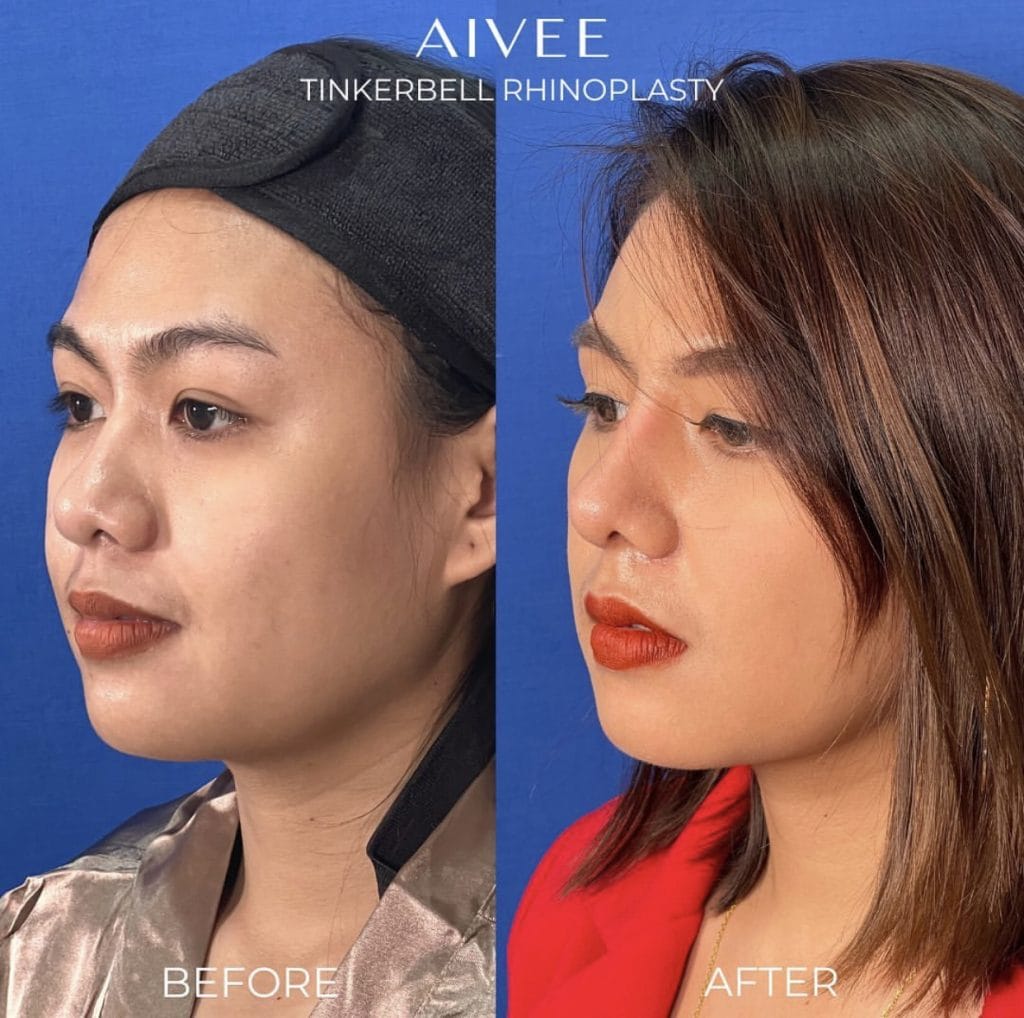 Our Results | The Aivee Clinic